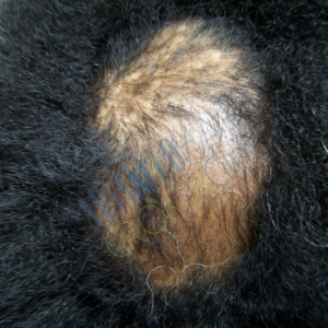 Dandruff or pityriasis capitis: Diffuse scaling – Manewellness Hair ...